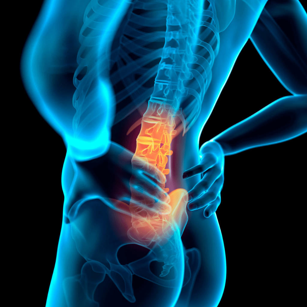 Have You Got a Blown Out Disc? - Posturepro Physio